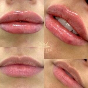 Natural Lips Package Highland Park | Lip Augmentation Chicago
