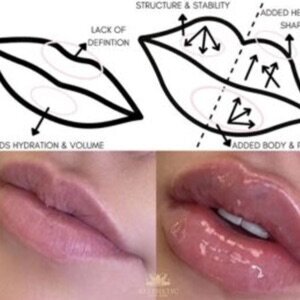 Natural Lips Package Highland Park | Lip Augmentation Chicago