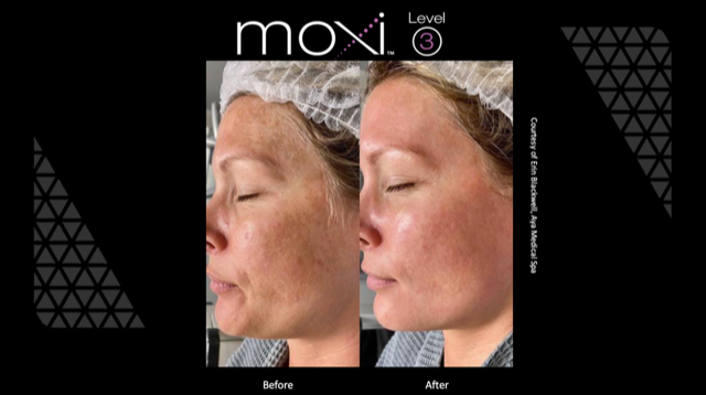 Moxi in Highland Park & Chicago, IL | Aesthetic Beauty Lounge